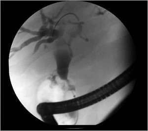 ERCP یا کلانژیوپانکراسکوپی رتروگراد - سایت رسمی دکتر غلامرضا رضامند فوق ...